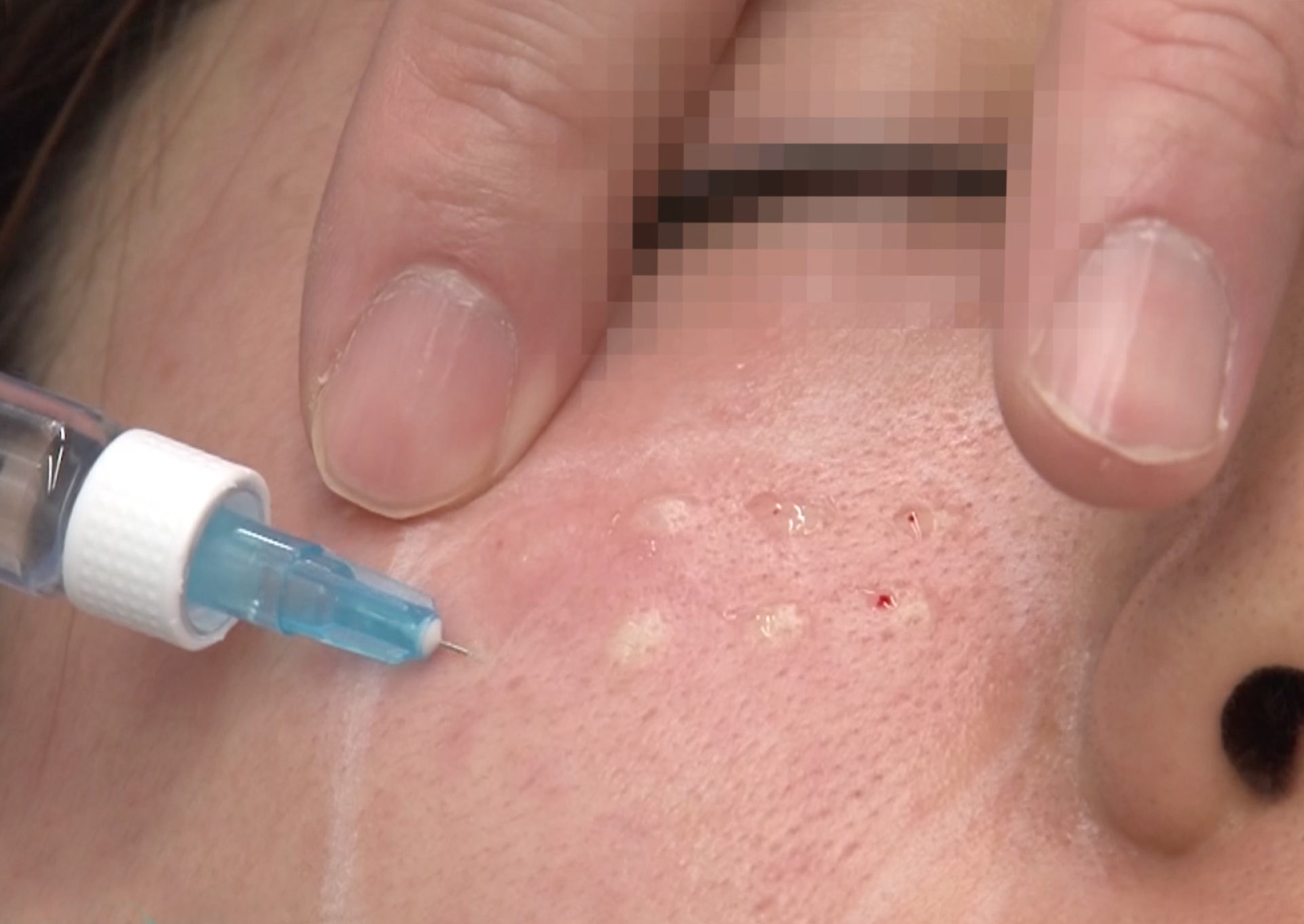 Rejuran Healer Treatment - All You Need To Know - DemotiX