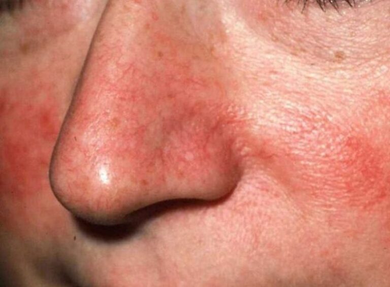 Reducing the Appearing of Rosacea - for Men