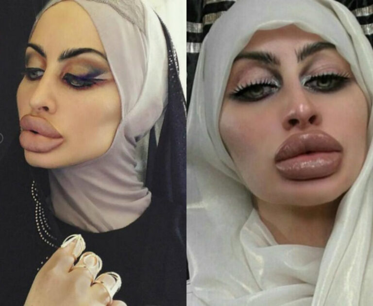 World Record Breaker: She Has the Biggest Lips in the World! - Demotix.com