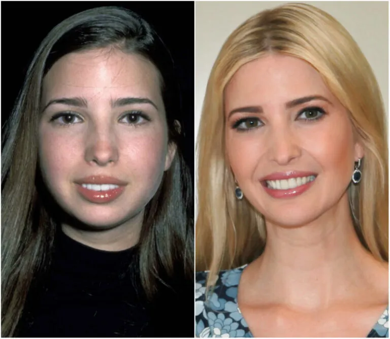 Before & After: All Ivanka Trump’s Plastic Surgeries and Cosmetic ...