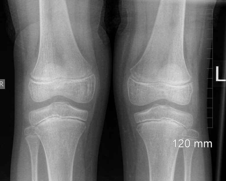 Knee X-ray: What It Shows, Interpretation Of The X-ray - 2024 Guide ...