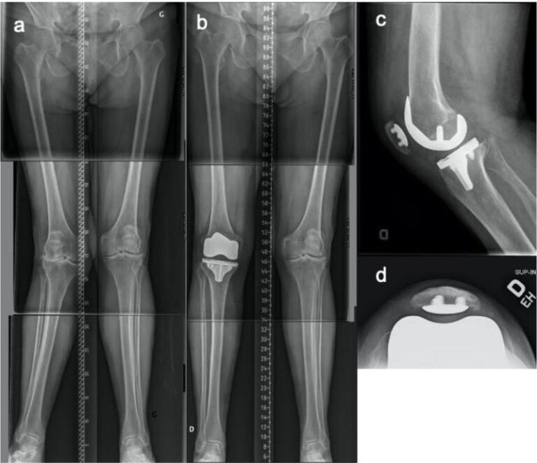 Knee X-ray: What It Shows, Interpretation Of The X-ray - 2024 Guide ...